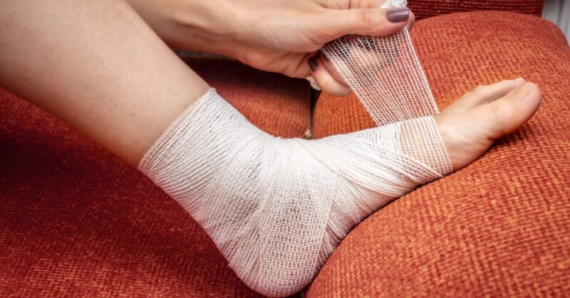 Kidner Procedure Nashville, TN | Orthopedic Surgery